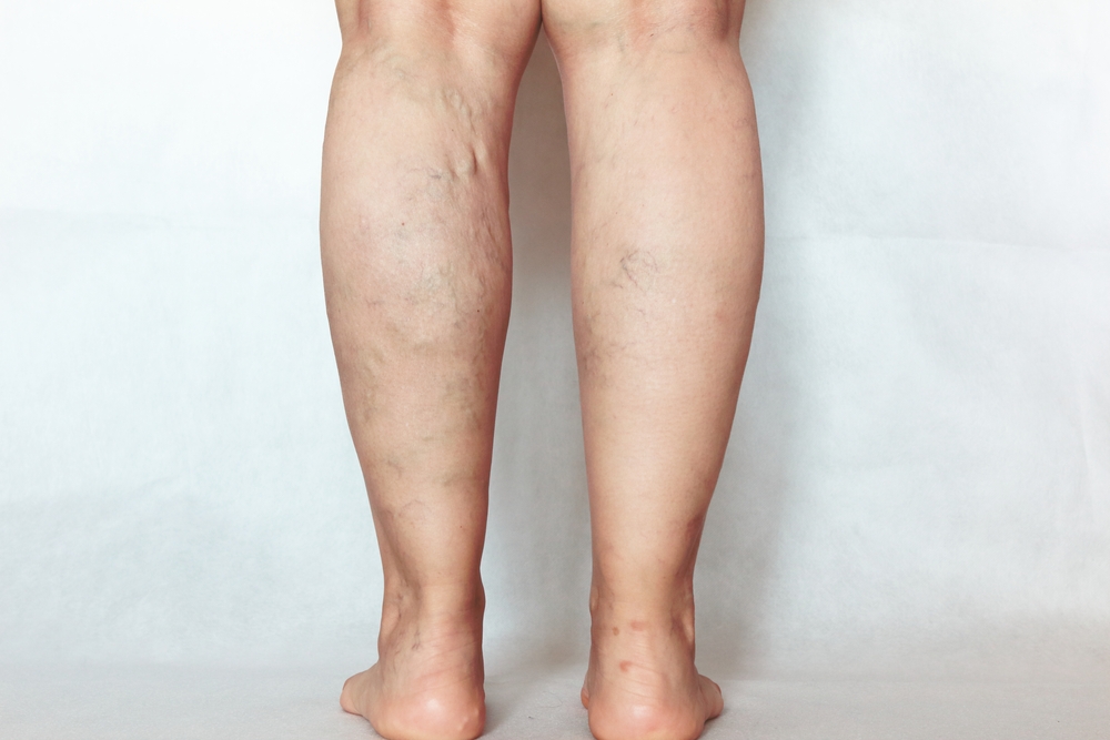 Recognizing the Early Warning Signs of DVT - FactAvenue