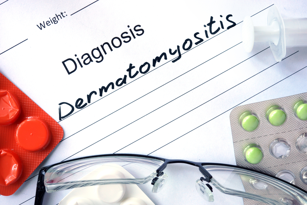 Dermatomyositis Infusion Treatments: What You Need to Consider - FactAvenue